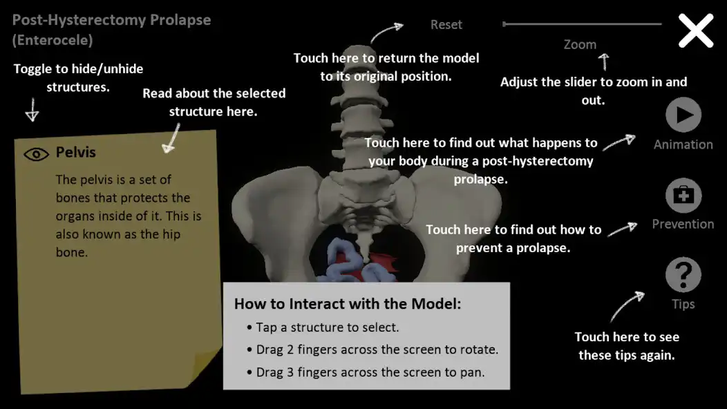 myProlapse: Anatomy of Post-Hysterectomy Prolapse online game with UptoPlay